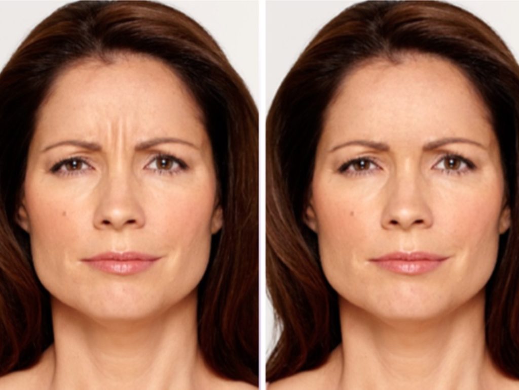 Fillers and Botox - Maviva Spa